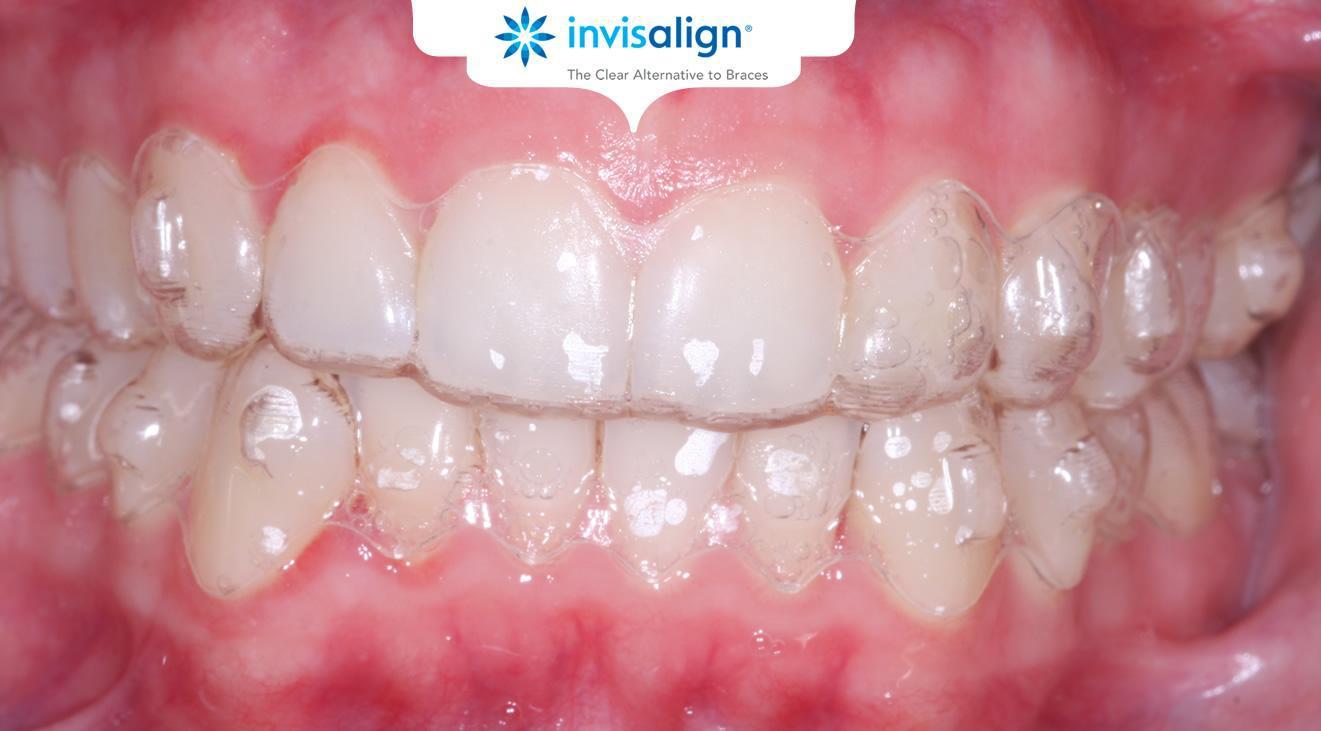 Should you Choose Fixed Braces or Invisalign?